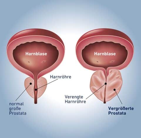 Gutartige Prostatavergrößerung (BPH): Infos | APOPROSTAT®